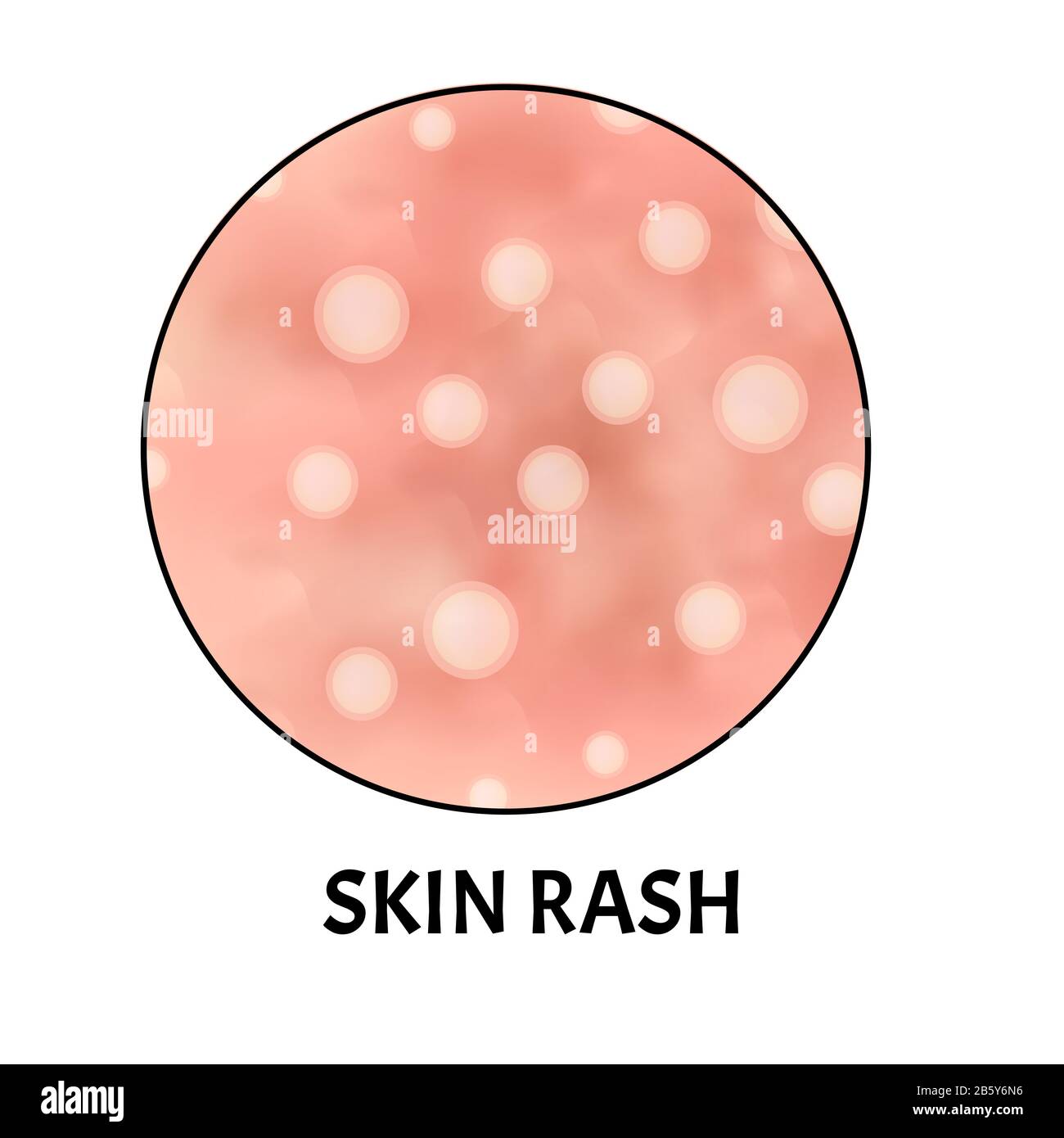 Skin Rash Symptom Of Dermatitis Allergies Psoriasis Eczema Icons