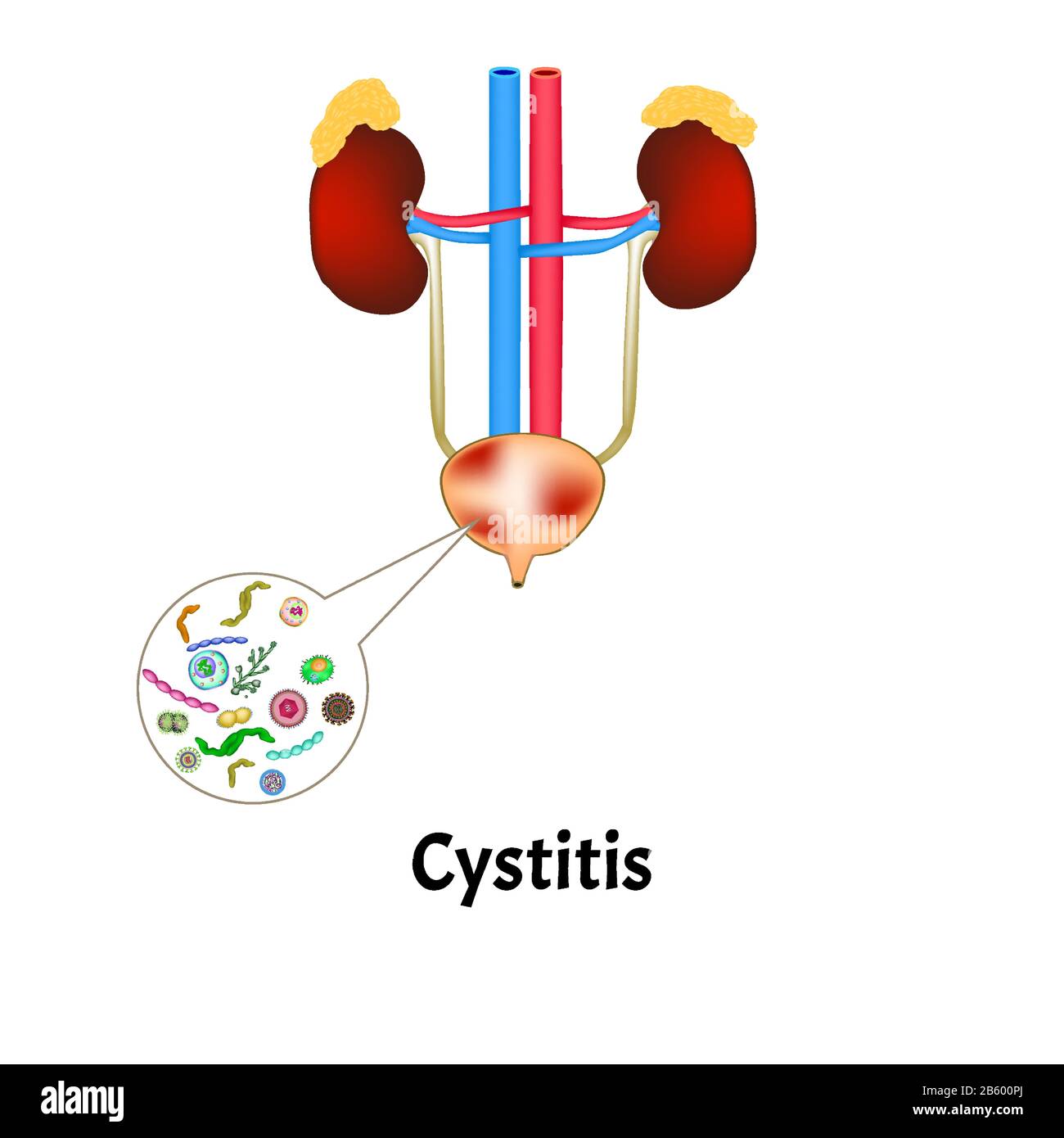 Cystitis. Inflammation of the bladder. The structure of the kidneys and ...