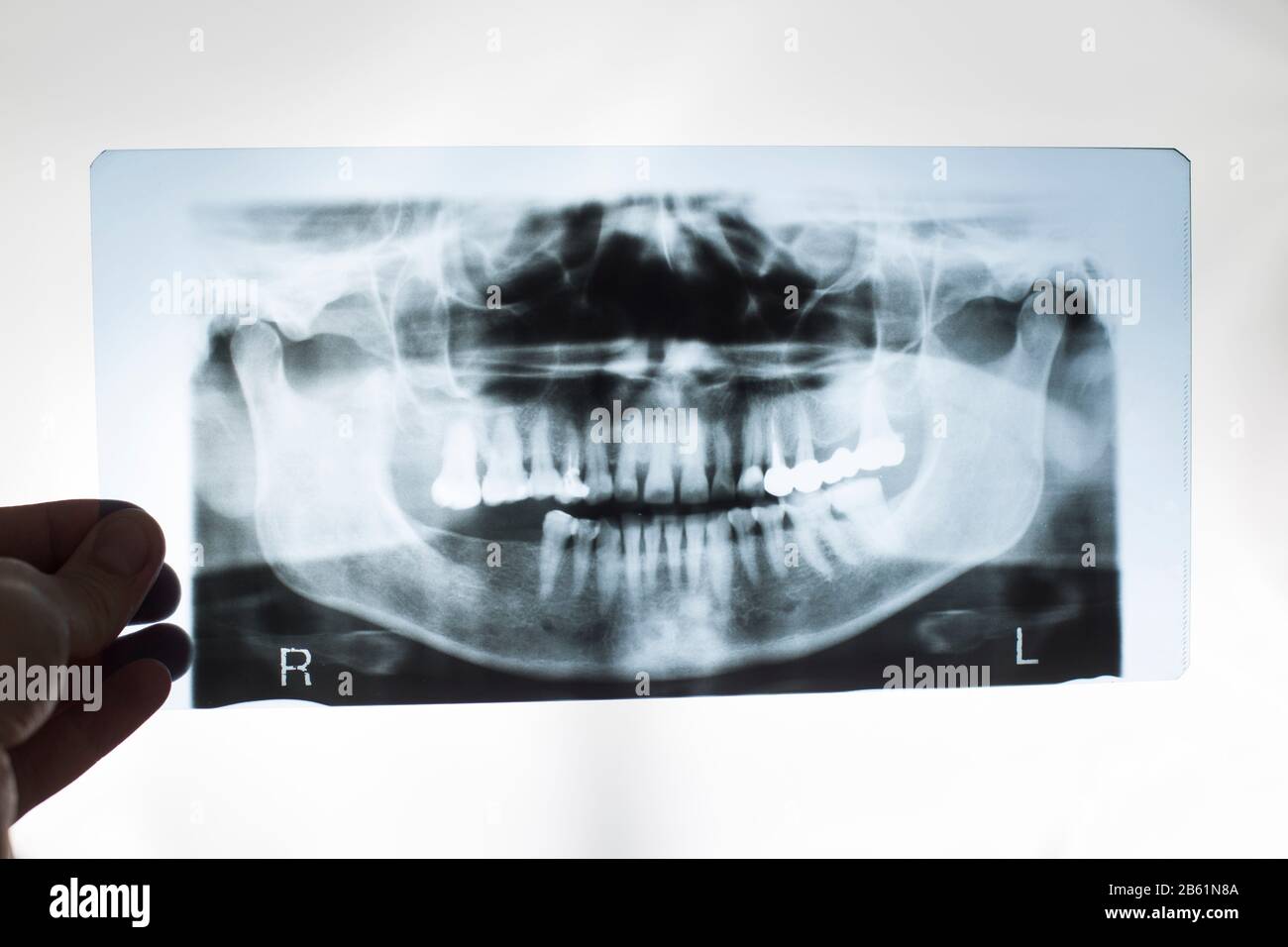 Splinting teeth hi-res stock photography and images - Alamy