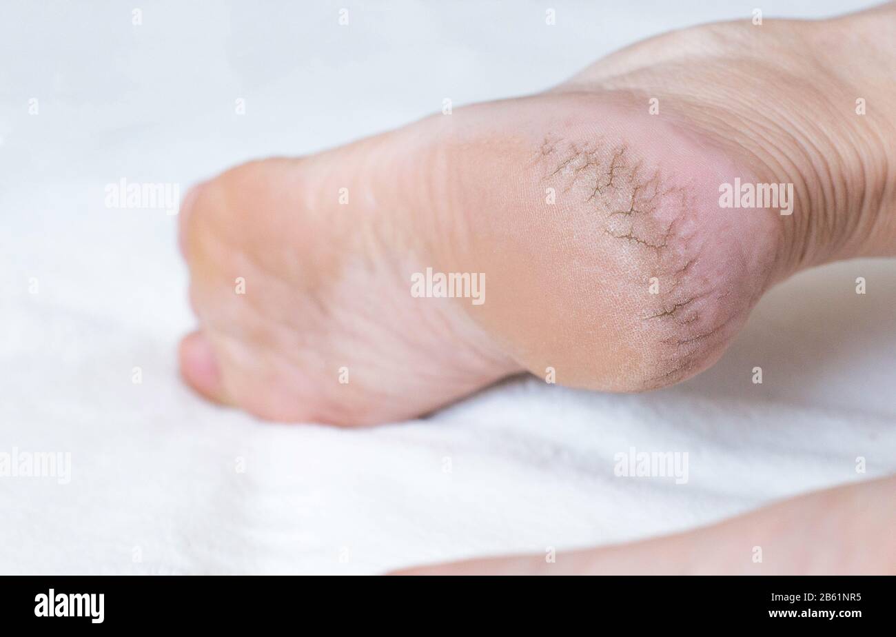 Dry cracked skin on the heels of a person s legs, close-up. The concept ...