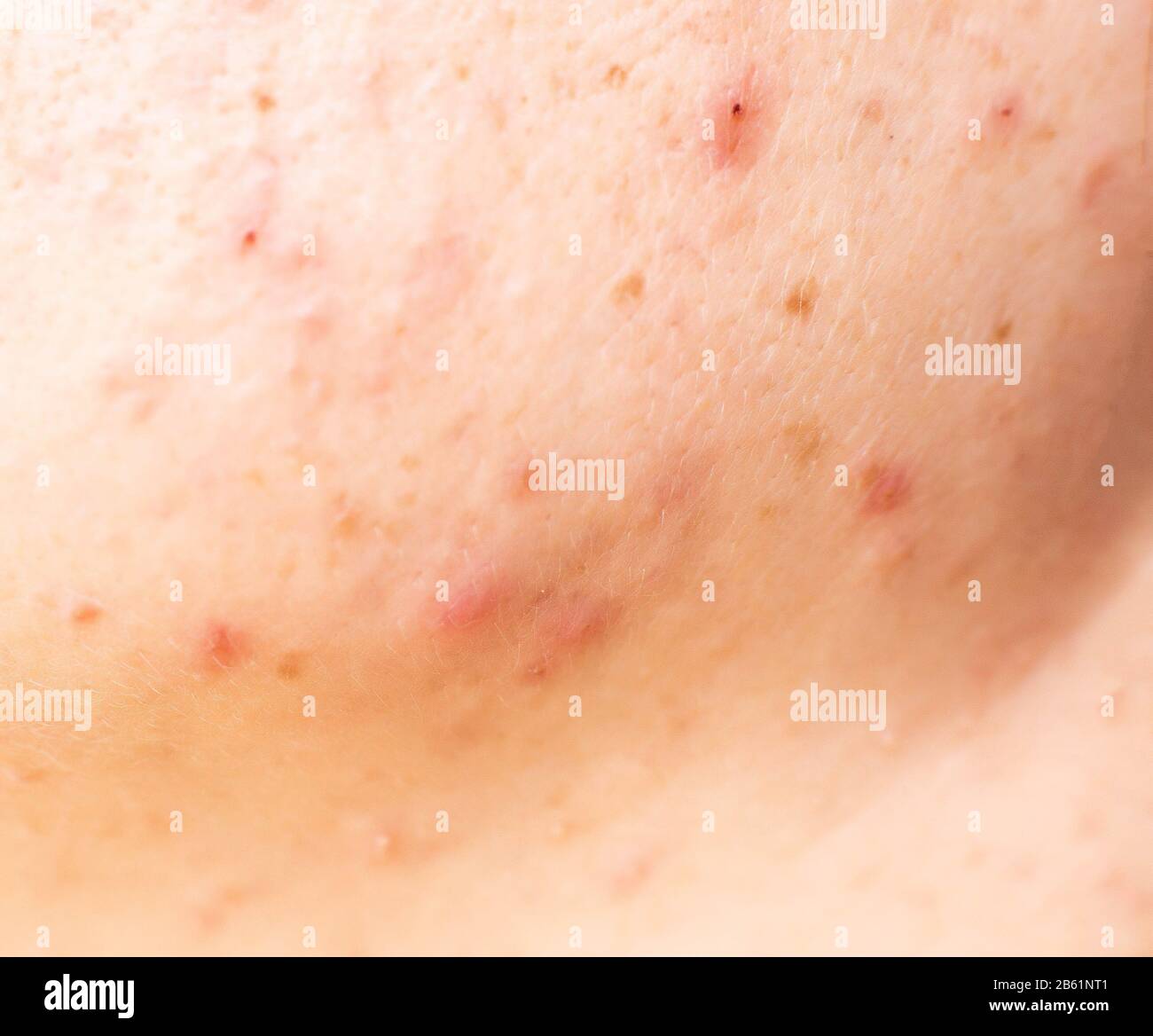 Red acne on the girl's face, background Stock Photo - Alamy