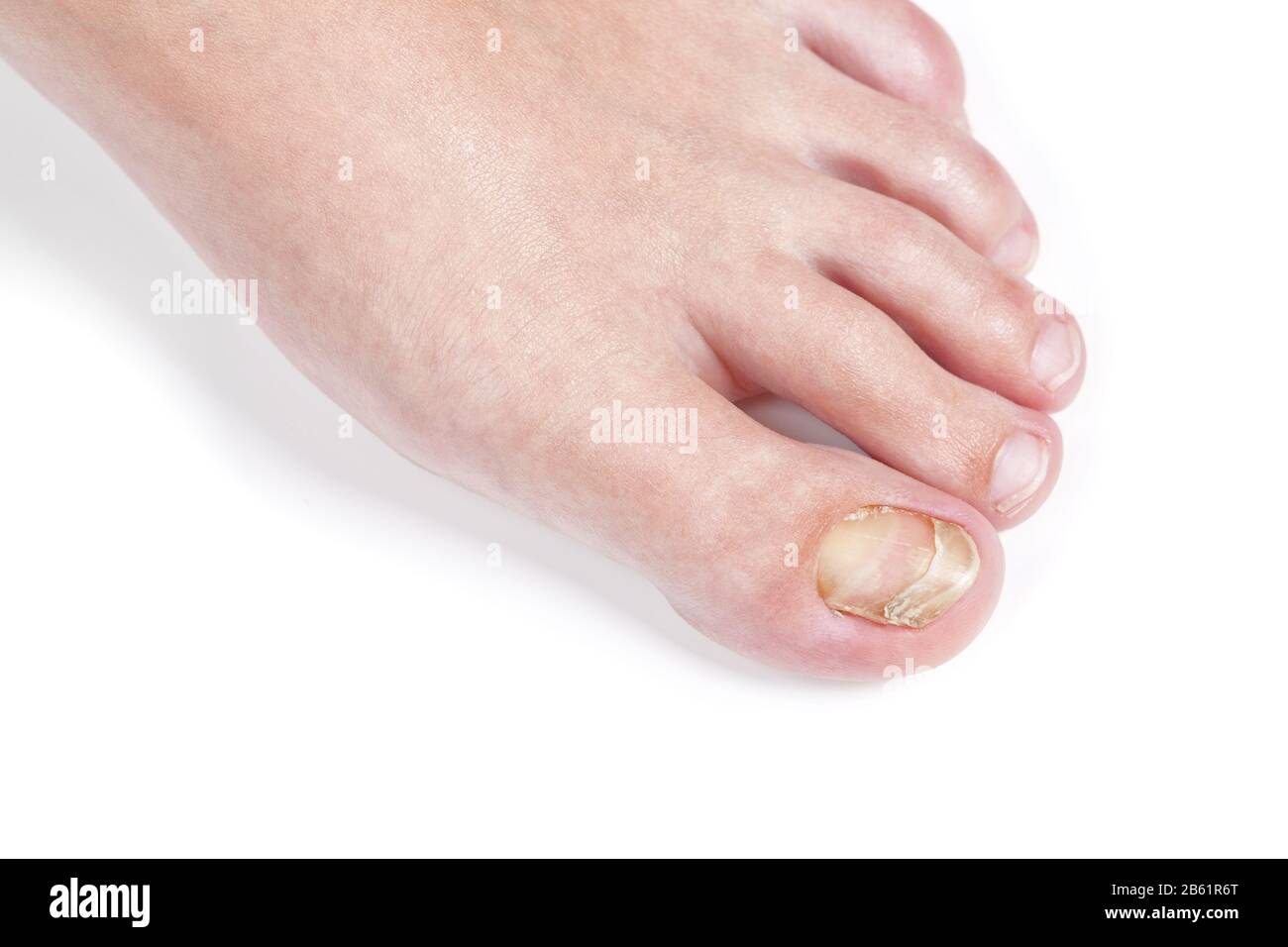Skin fungus on the nail, on the female foot. Close-up Stock Photo - Alamy