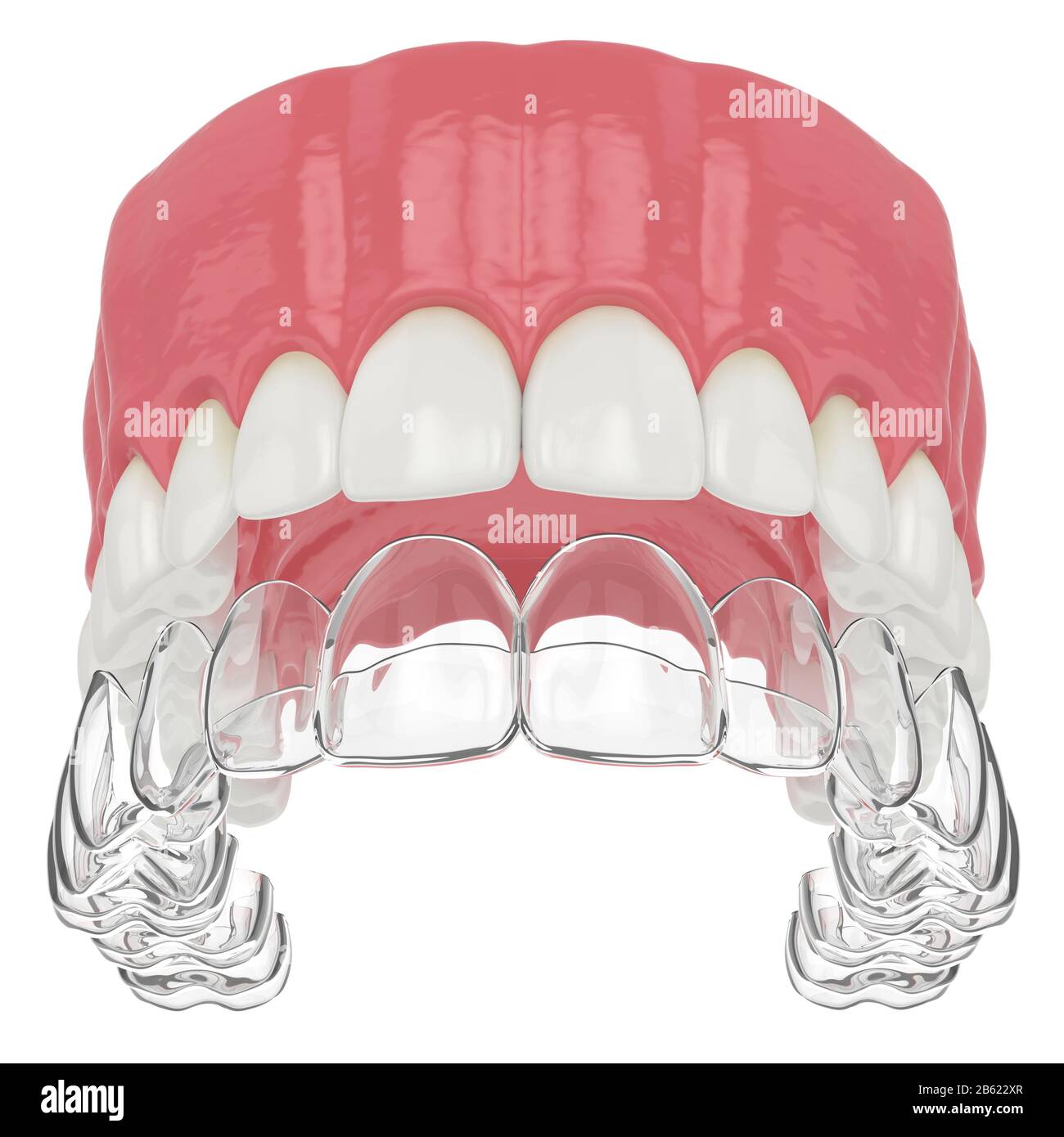 3d render of upper jaw with invisalign removable retainer over white ...