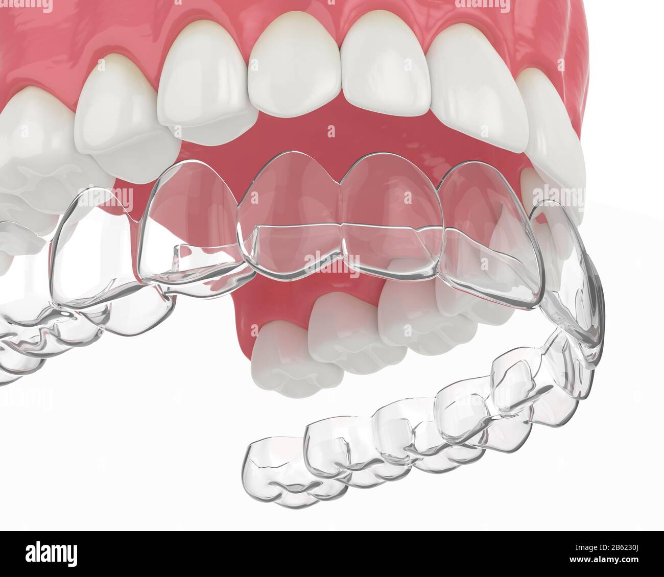 3d render of upper jaw with invisalign removable retainer over white ...