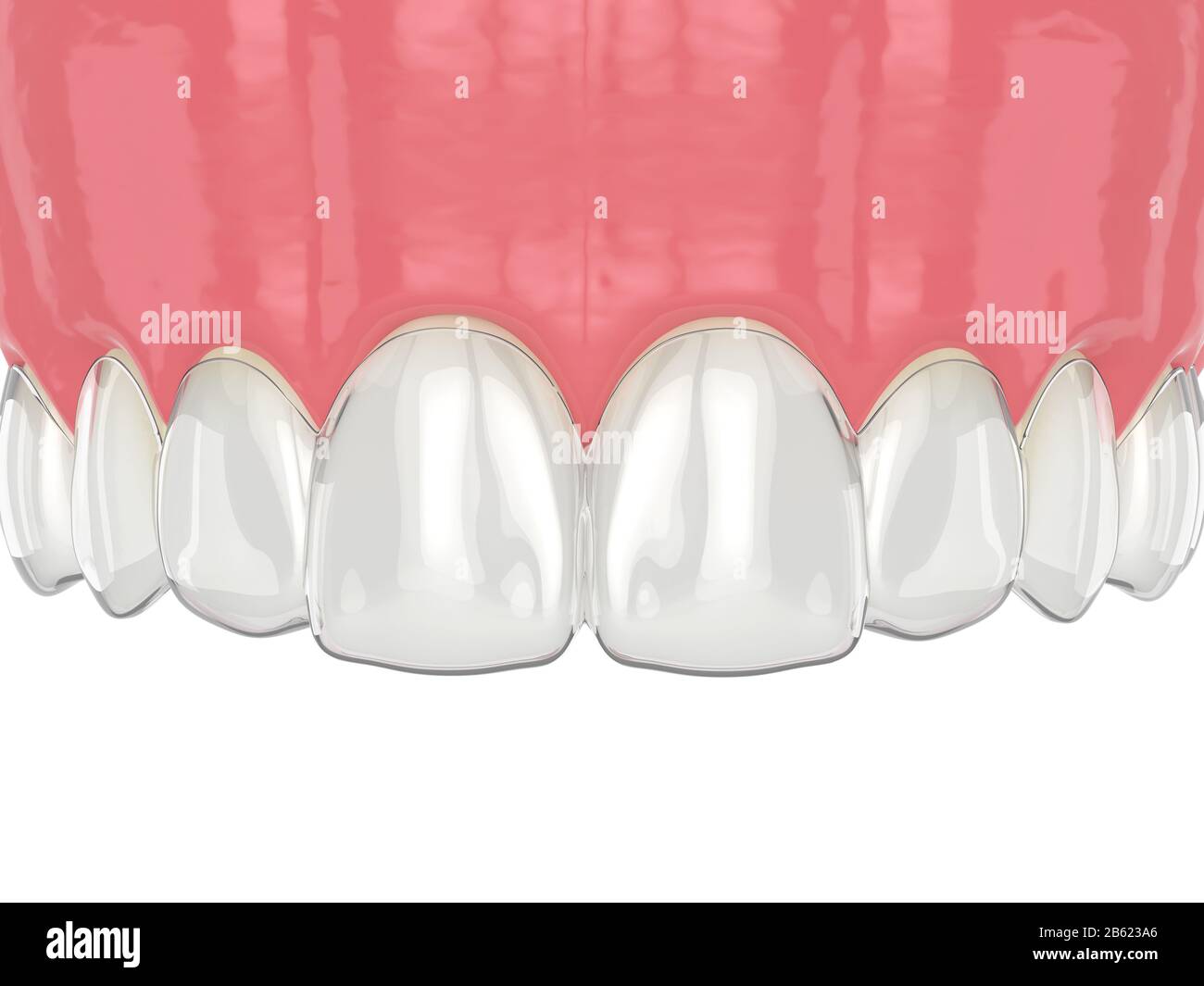 3d render of upper jaw with invisalign removable retainer over white ...