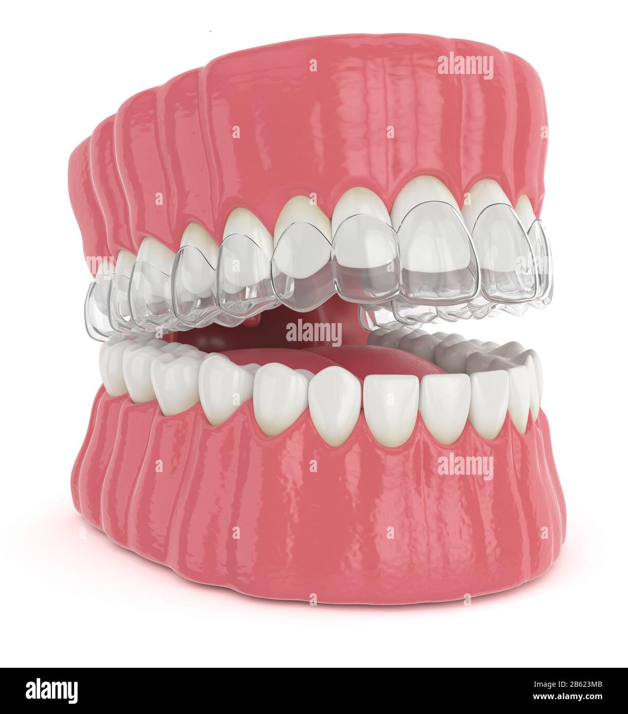 3d render of jaw with invisalign removable retainer over white ...