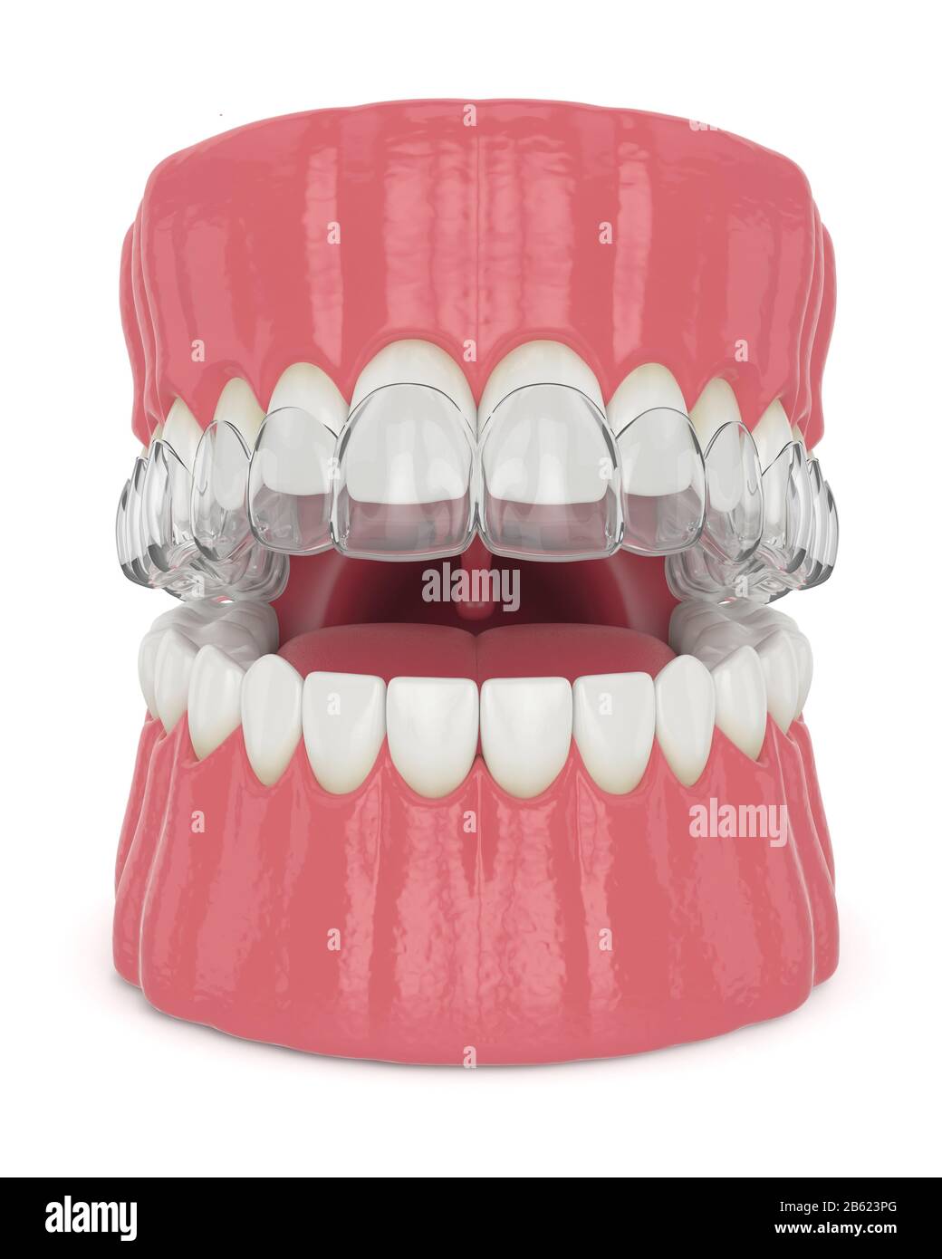 3d render of jaw with invisalign removable retainer over white ...