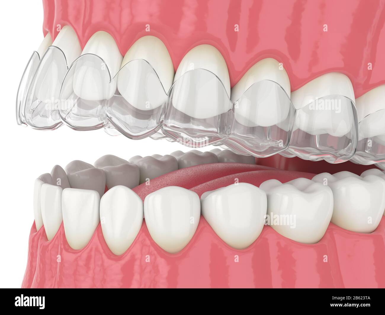 3d render of invisalign removable and invisible retainer on jaw over ...