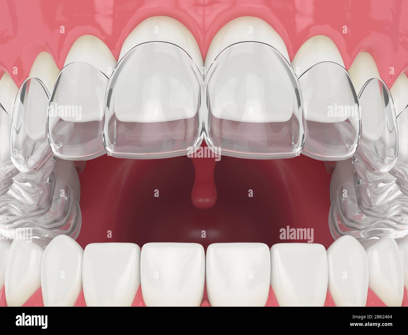 3d render of jaw with upper invisalign removable retainer Stock Photo ...