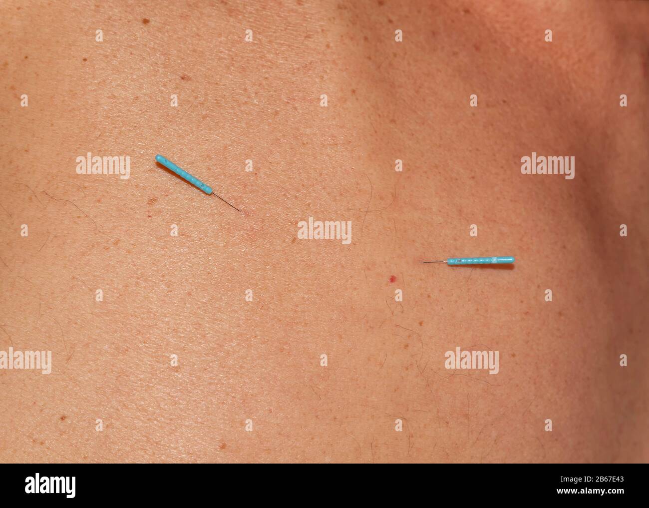 Receiving acupuncture treatment against pain Stock Photo - Alamy