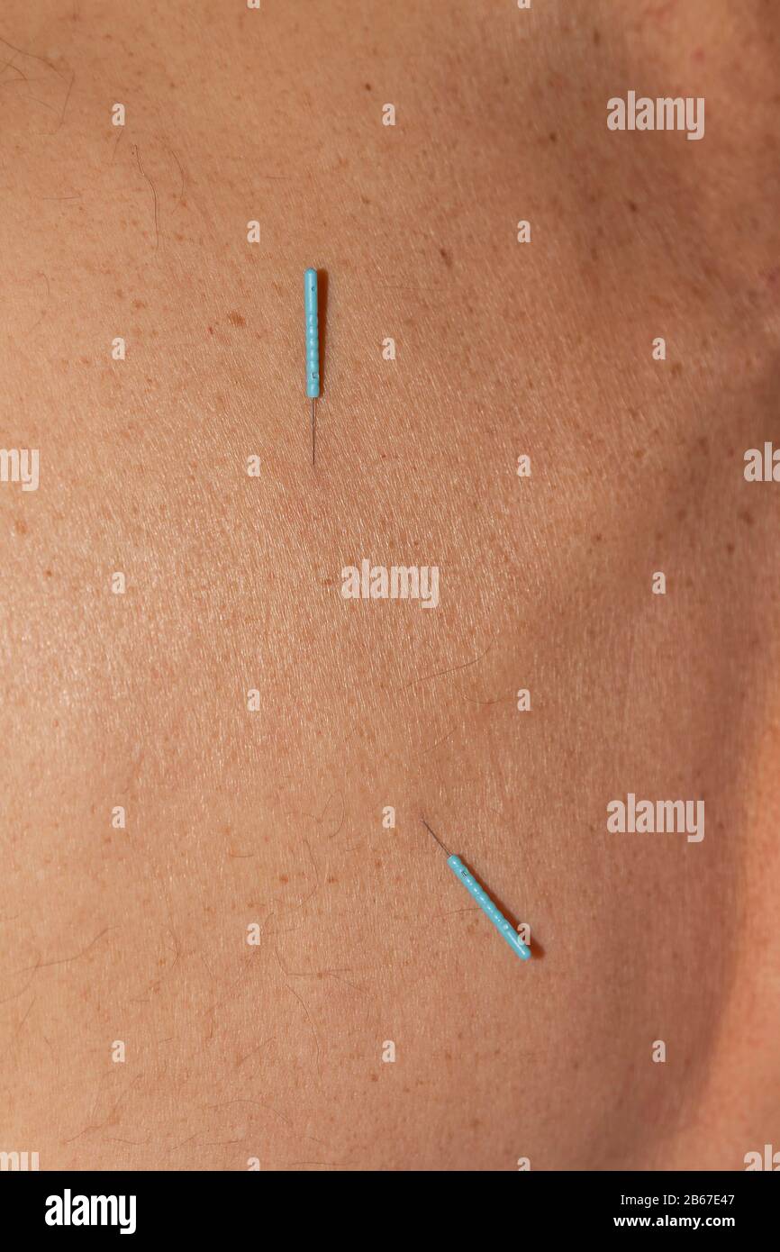 Acupuncture meridians china hi-res stock photography and images - Alamy