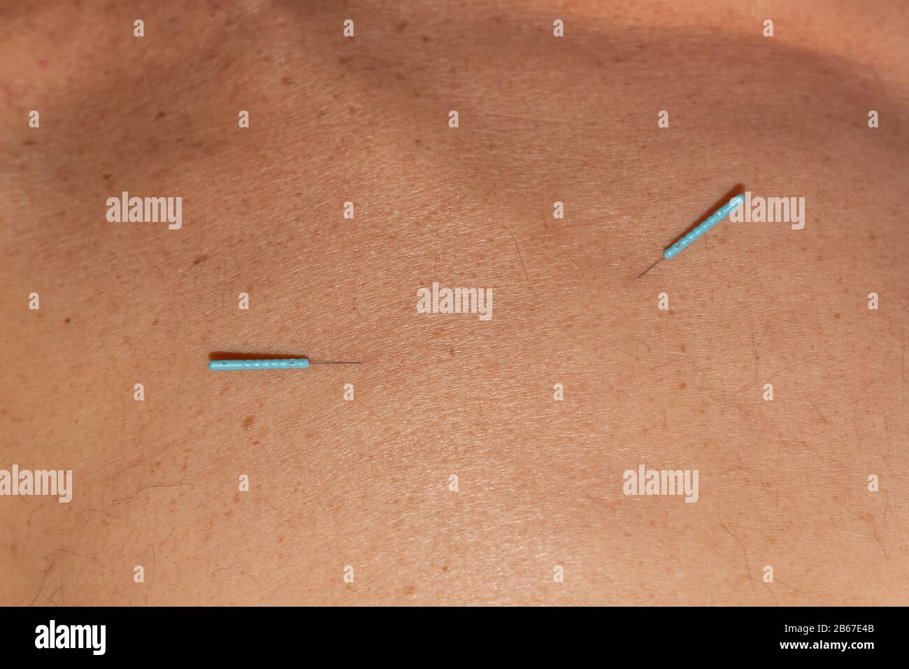 Acupuncture needle tcm china hi-res stock photography and images - Alamy