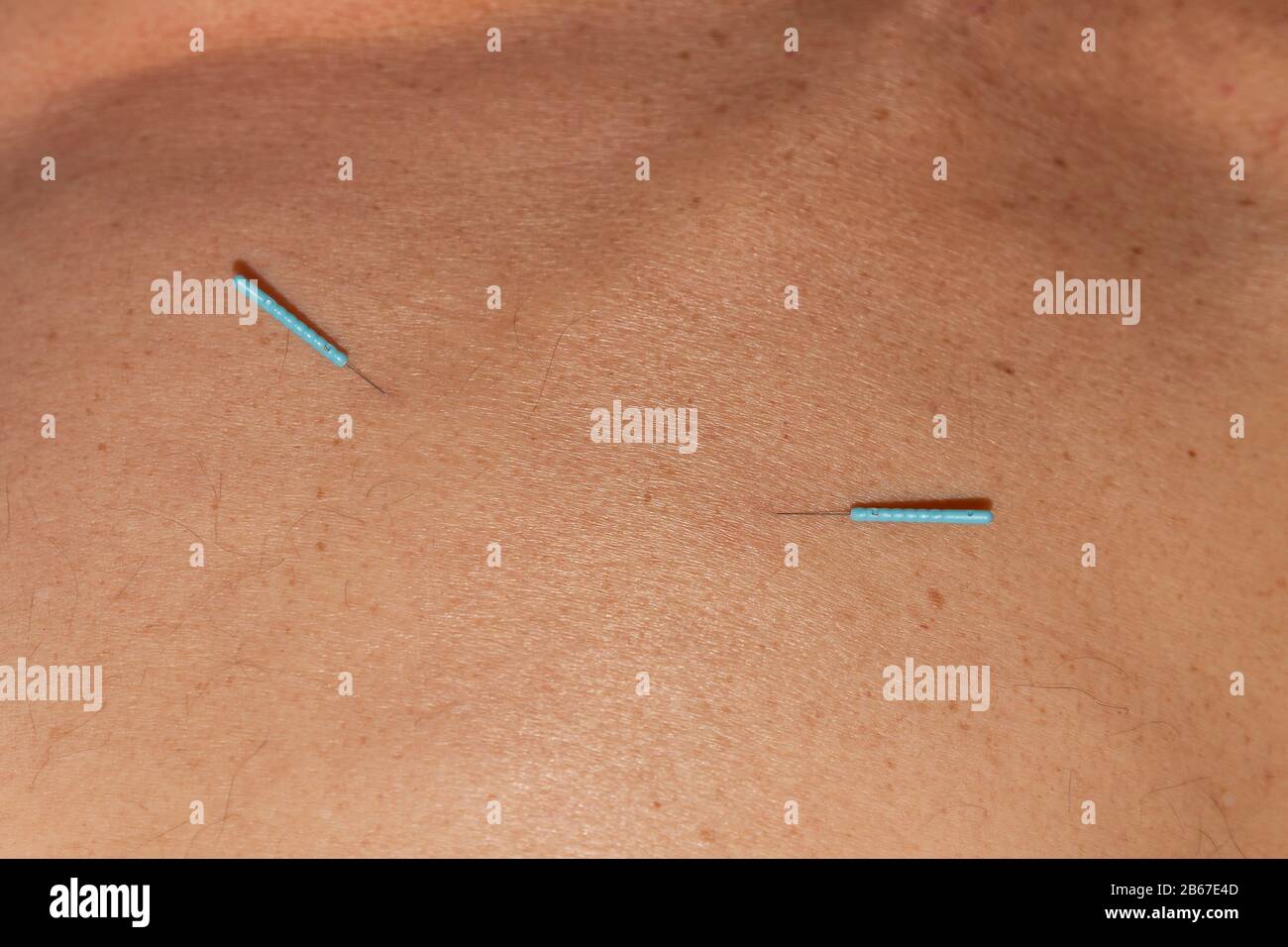 Acupuncture meridians china hi-res stock photography and images - Alamy