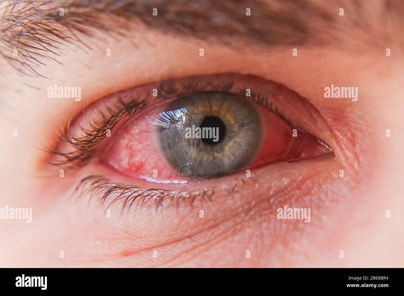 Macro close up of red eye with conjunctivitis infection Stock Photo - Alamy