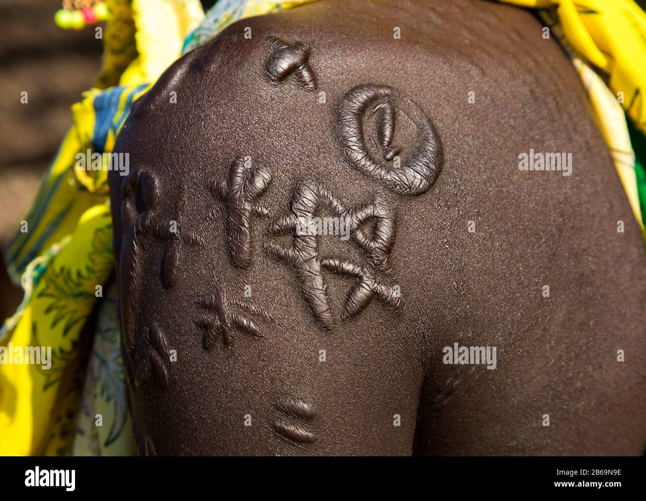 Shoulder scar hi-res stock photography and images - Alamy