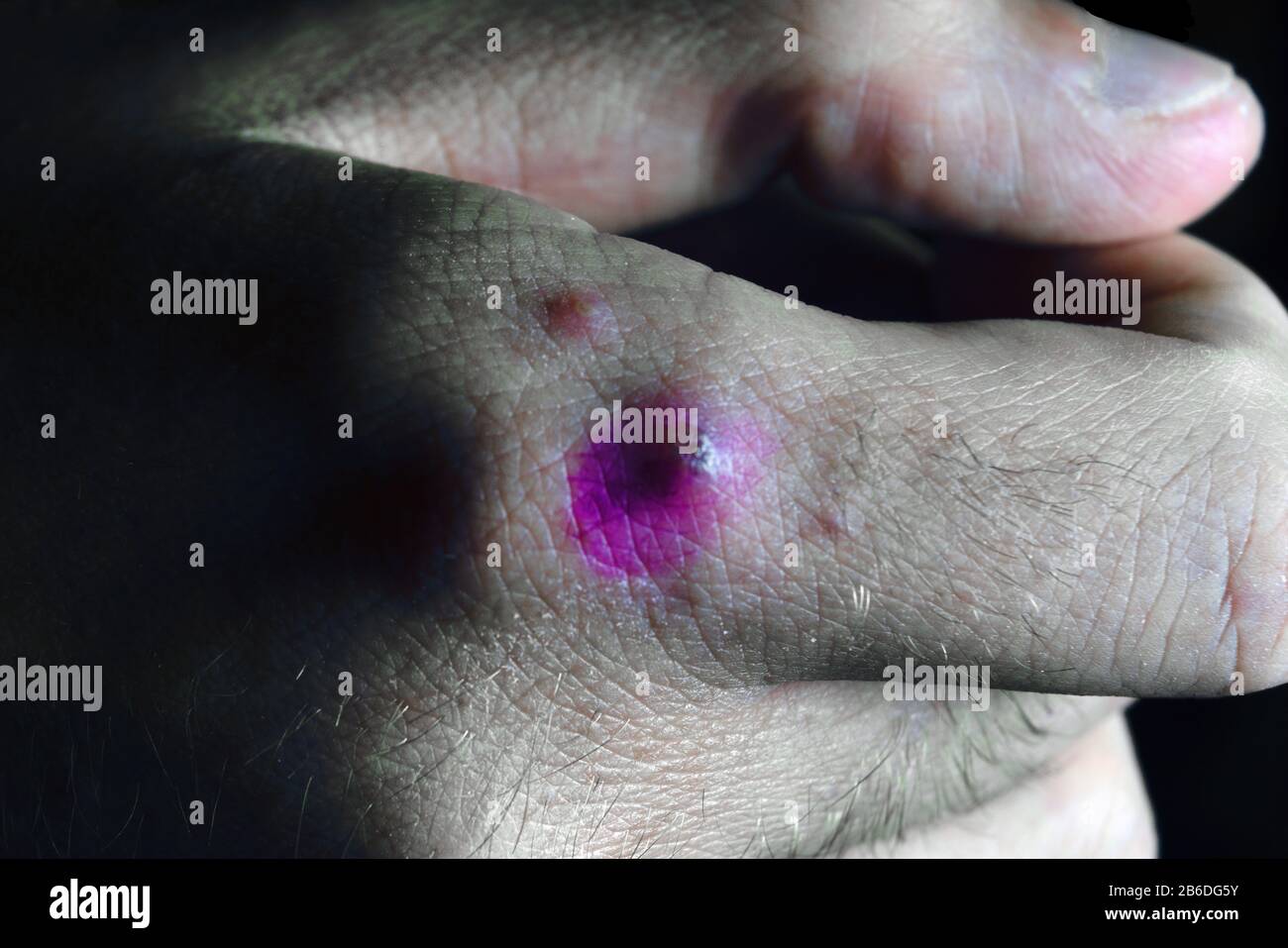 Papules on the skin of a patient with chickenpox close-up. Varicella ...