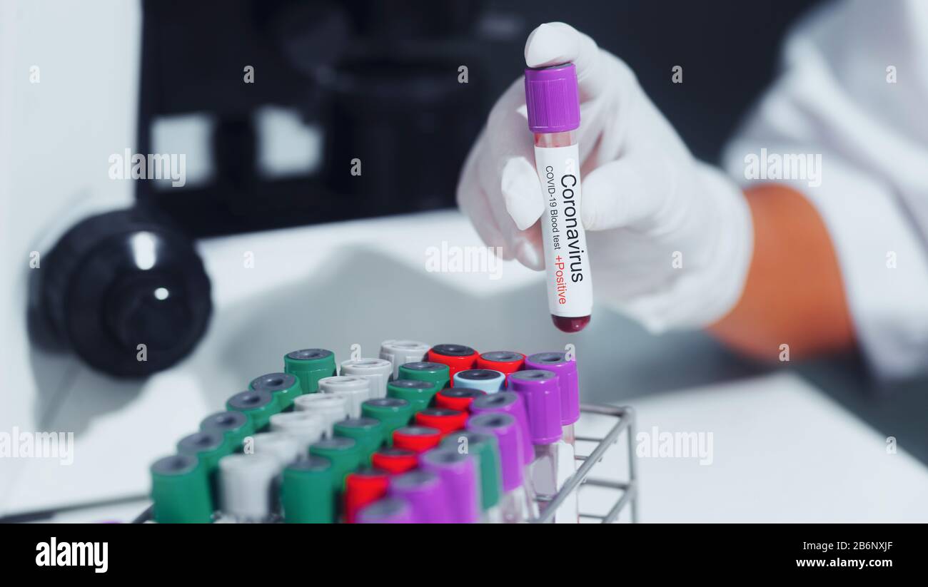 Positive blood test result for the new rapidly spreading Coronavirus ...