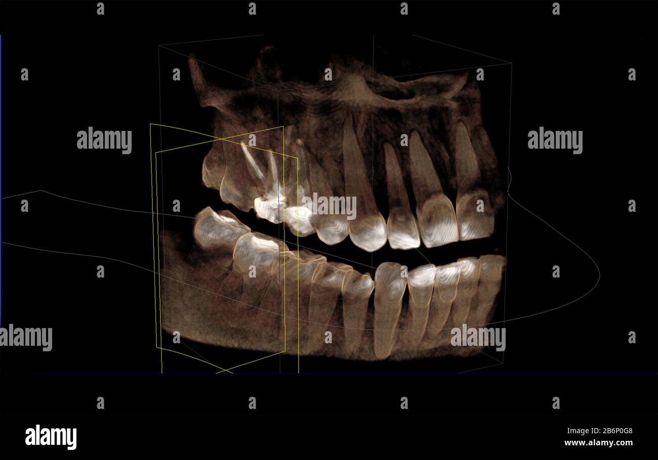 Tooth visualization hi-res stock photography and images - Alamy