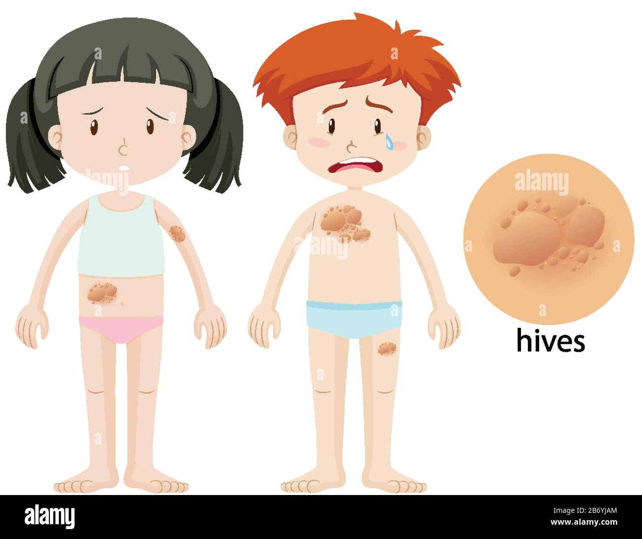 Diagram showing hives on boy and girl illustration Stock Vector Image ...