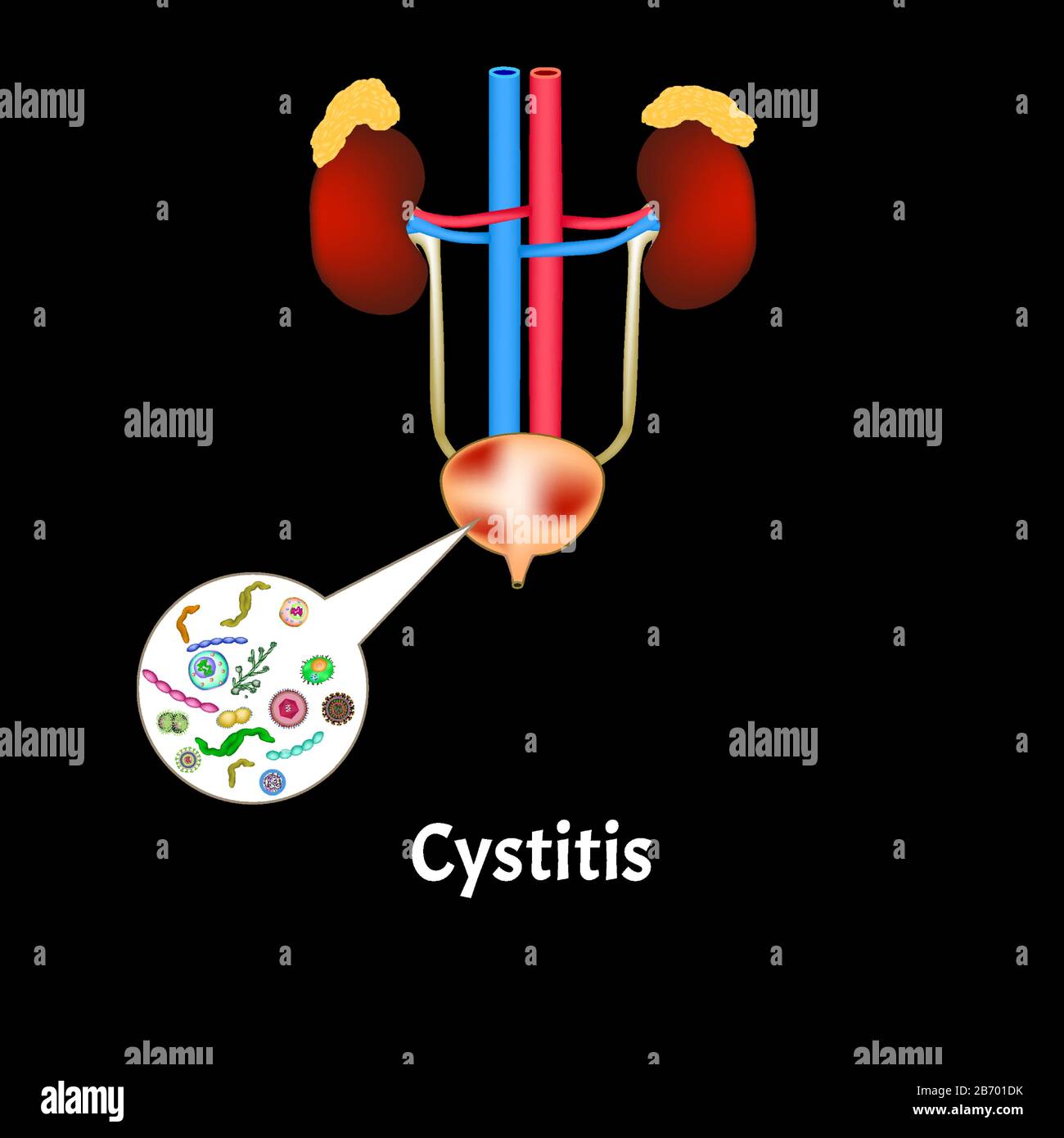 Cystoscopy hi-res stock photography and images - Alamy