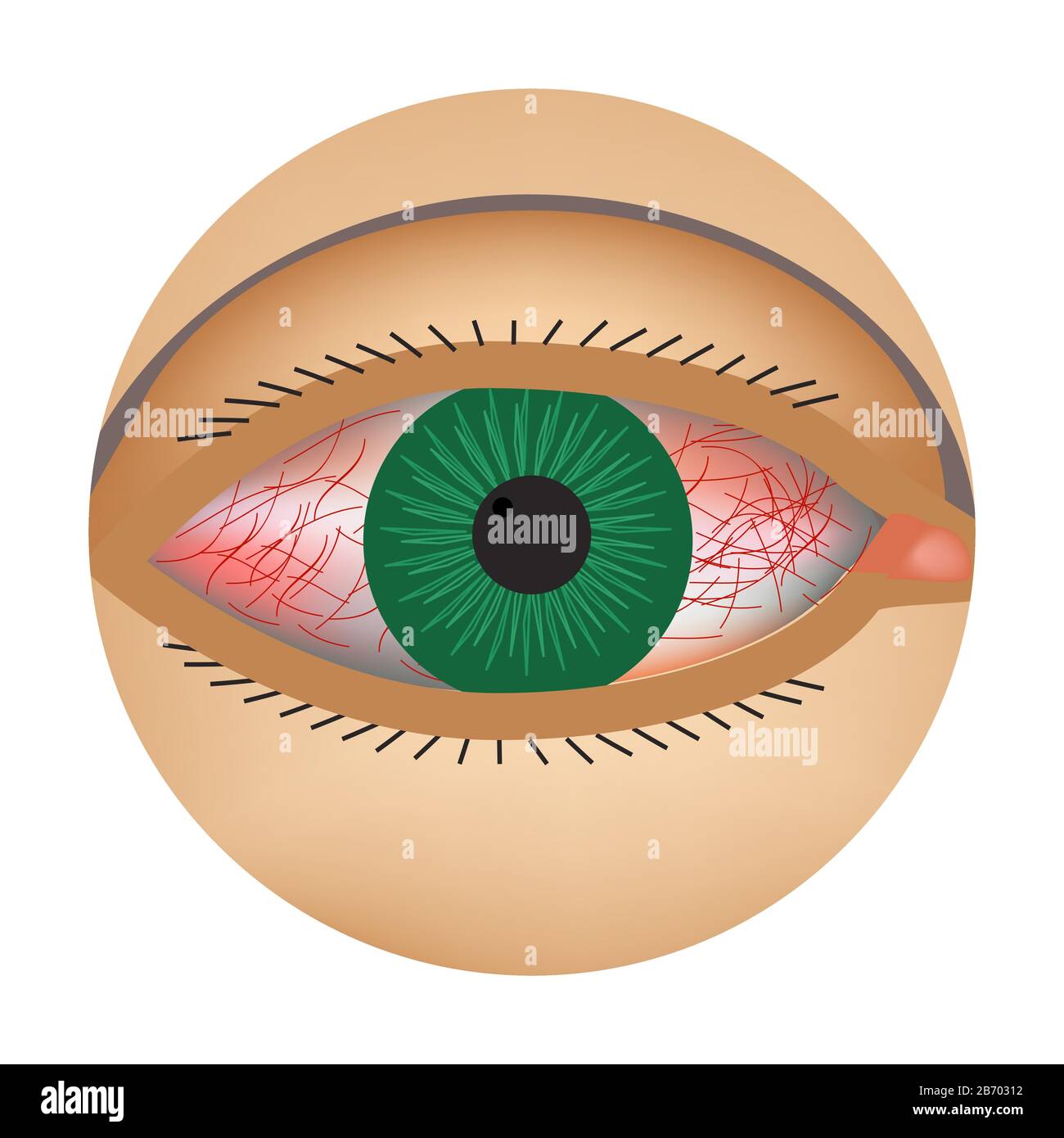 Skin and eye irritation Cut Out Stock Images & Pictures - Alamy