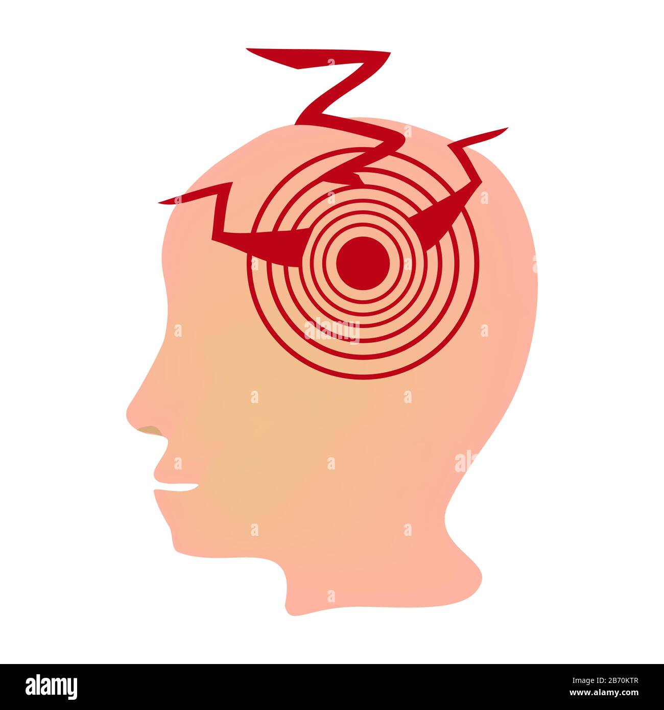 Headache. Symptom of influenza, allergies, bronchitis, pneumonia ...
