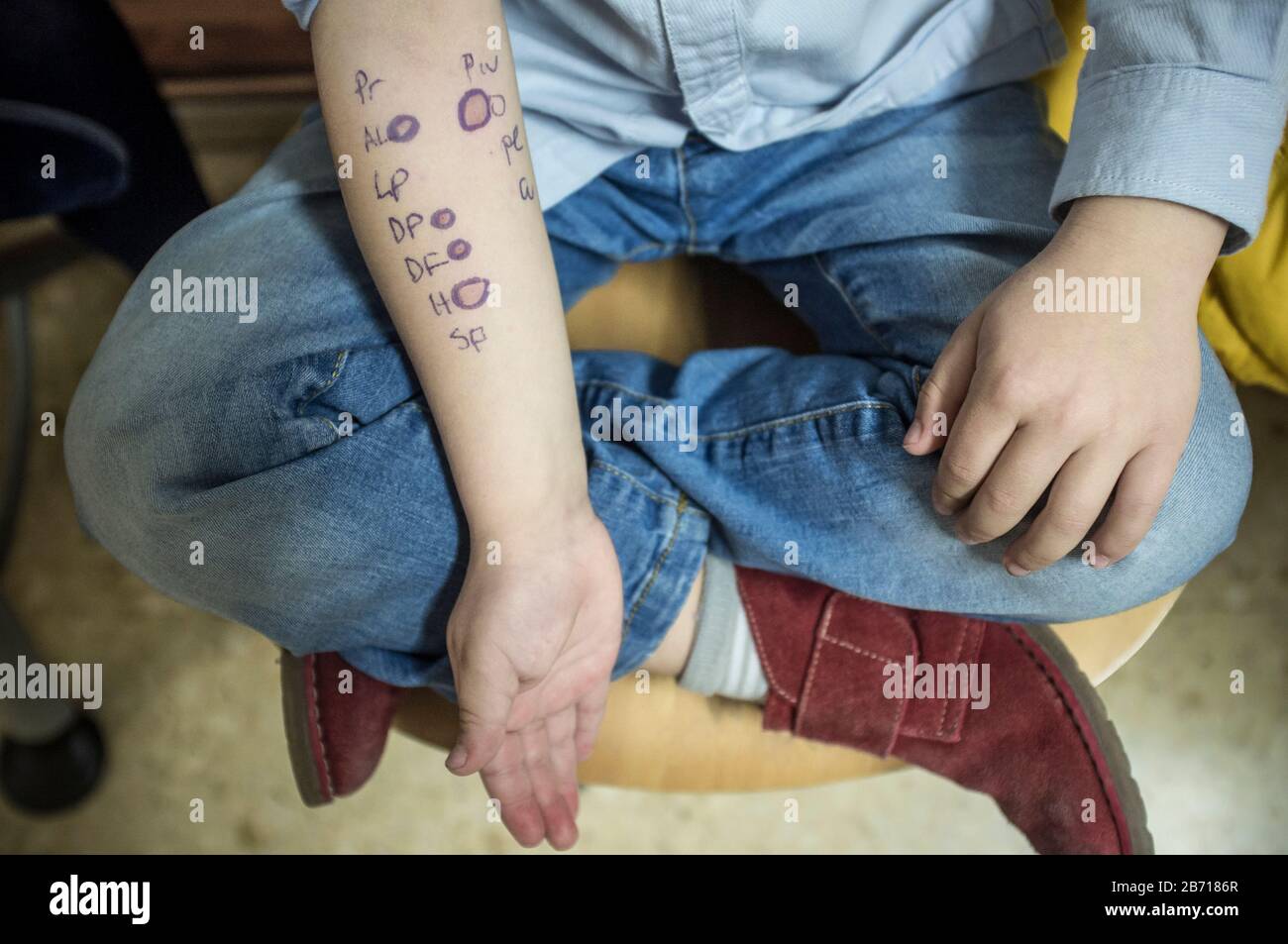 Little boy shows his arm after nurse encircled the allergy positive ...