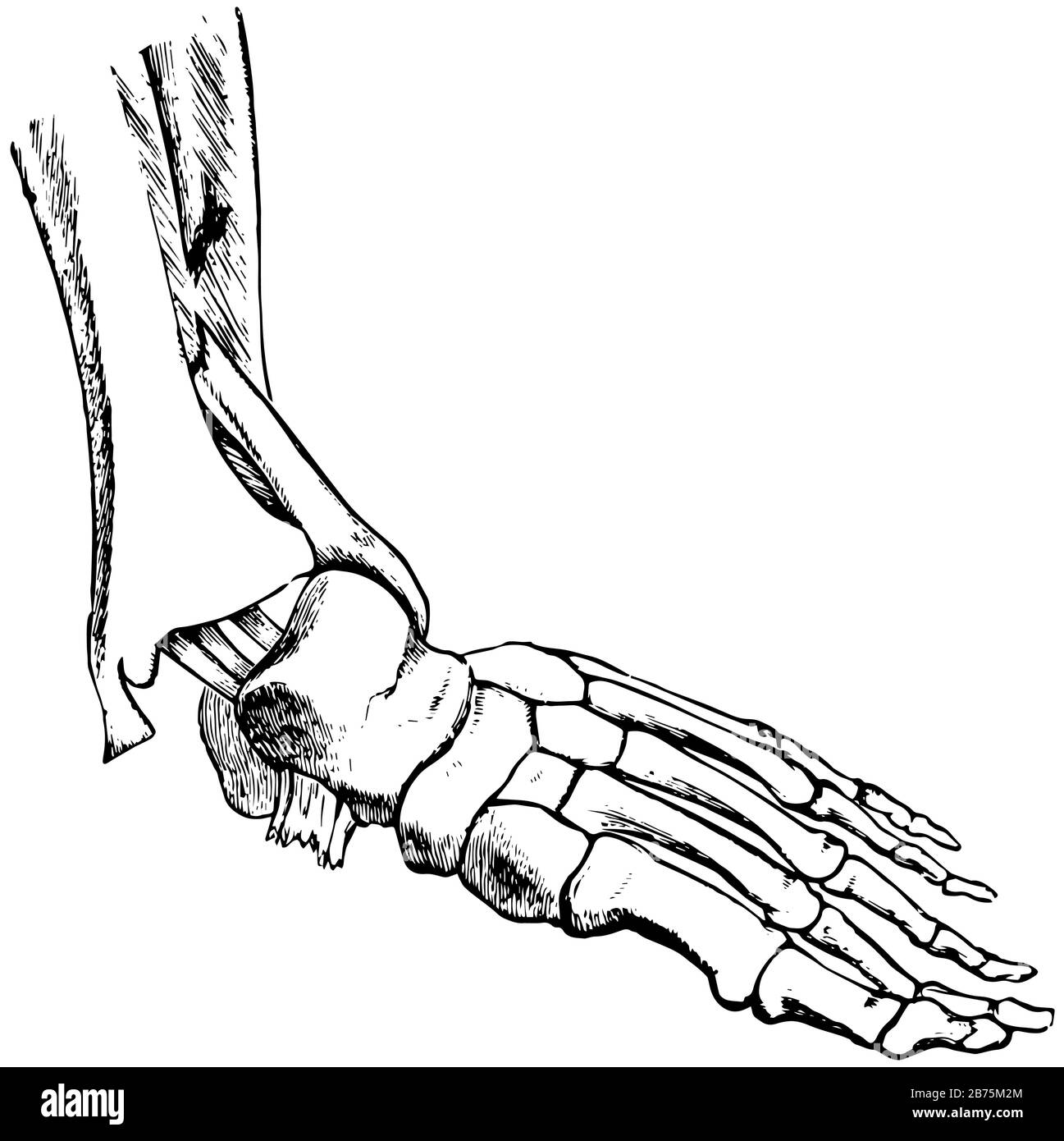 This illustration represents Fractured Fibula, vintage line drawing or ...