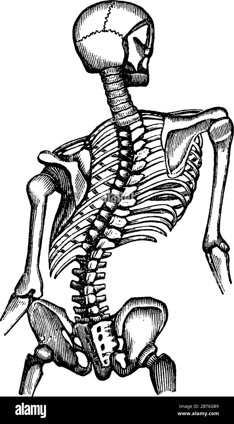 This illustration represents Deformed Thorax, vintage line drawing or ...