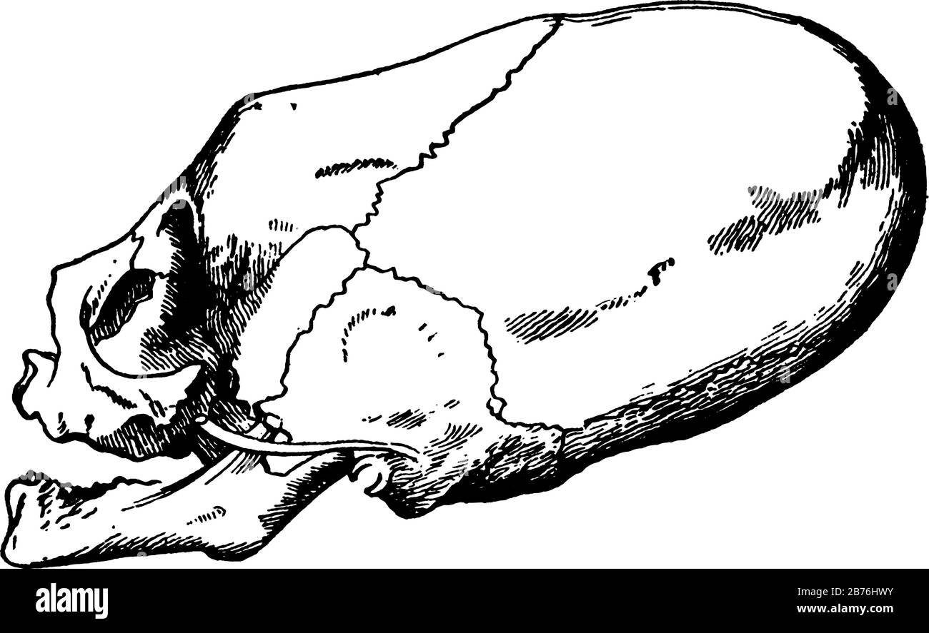 This illustration represents Distorted Skull of Child, vintage line ...