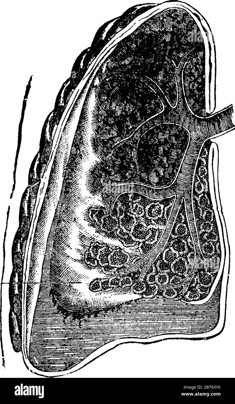 Pneumonia lung hi-res stock photography and images - Alamy