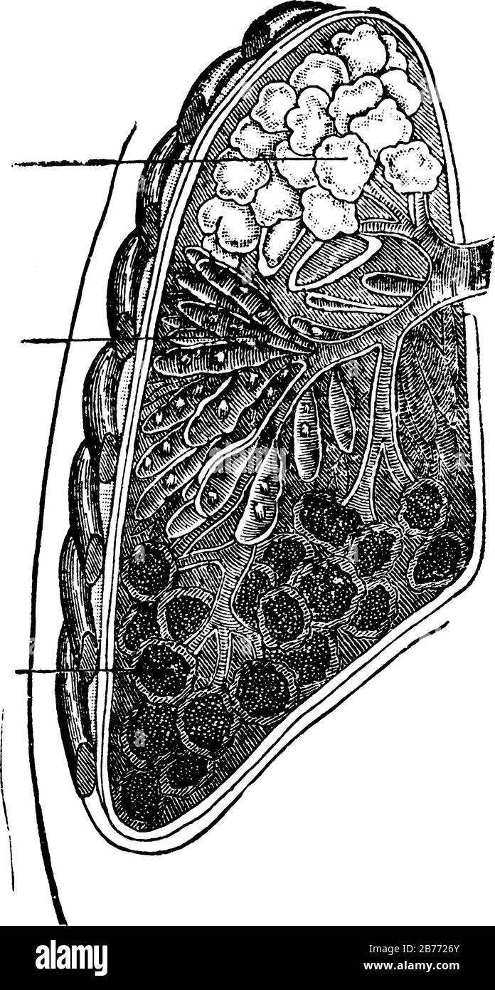 Pneumonia lung drawing Black and White Stock Photos & Images - Alamy
