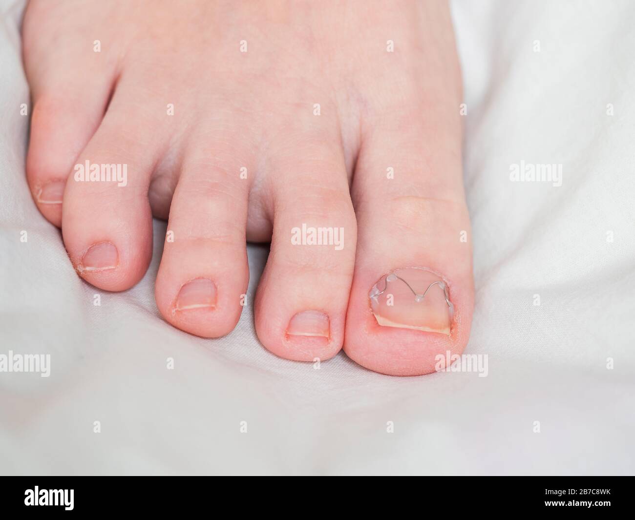 Orthonyx Bracket, toenail clamp is mounted on an ingrown toenail, close ...