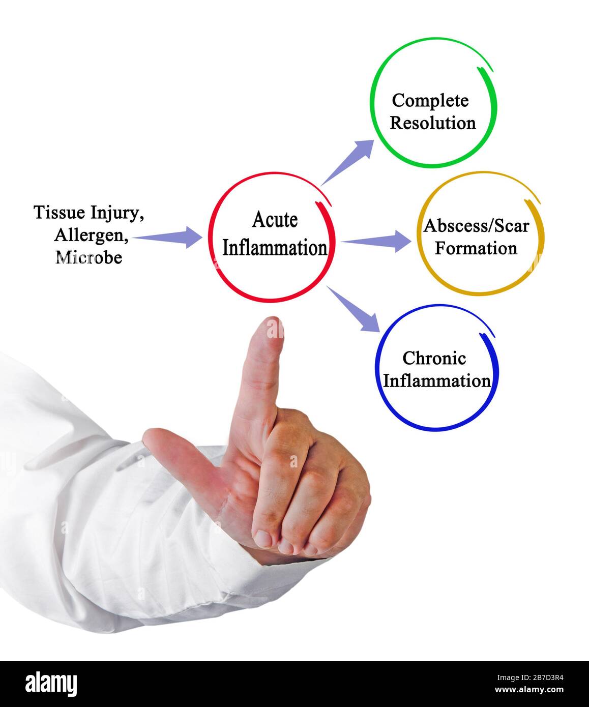Three ways of resolution of acute inflamation Stock Photo - Alamy