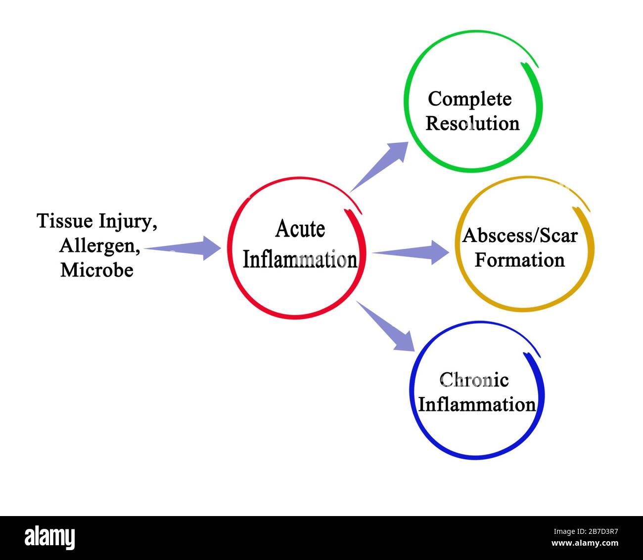 Three ways of resolution of acute inflamation Stock Photo - Alamy