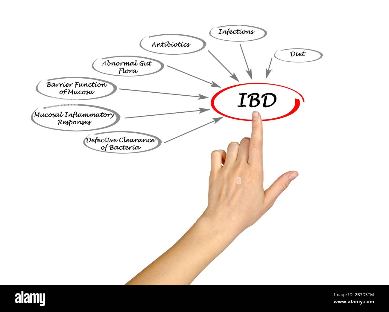 Causes of Inflammatory bowel disease Stock Photo - Alamy