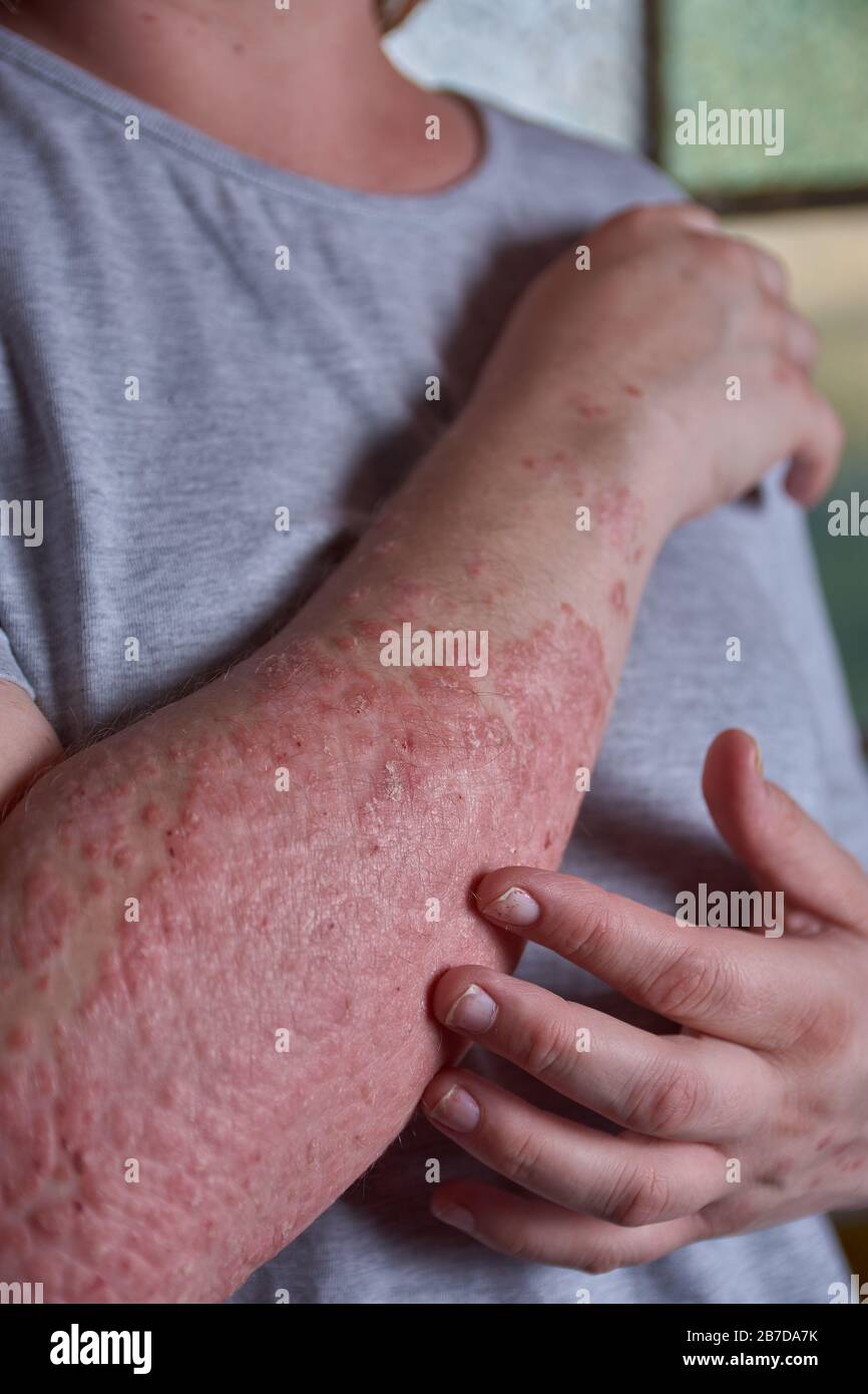 Forearm view of woman with Psoriasis Stock Photo - Alamy