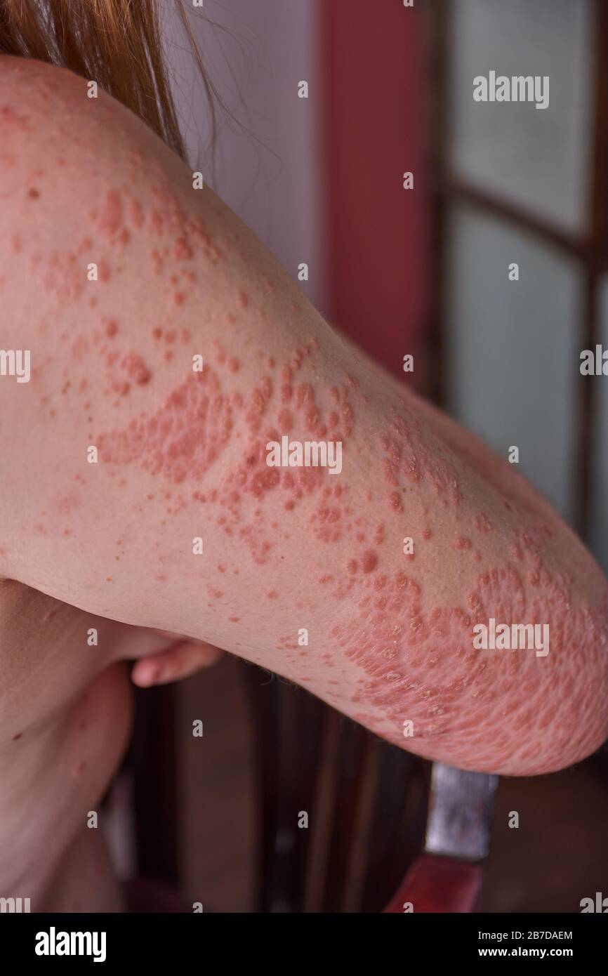 Eczema skin rash elbow arm hi-res stock photography and images - Alamy