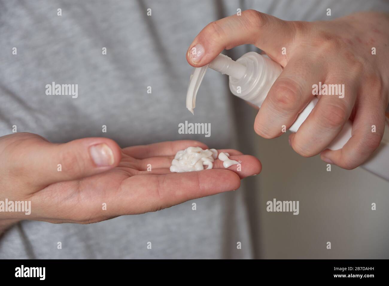 Woman hand using dispenser to apply cream on skin with Psoriasis Stock ...