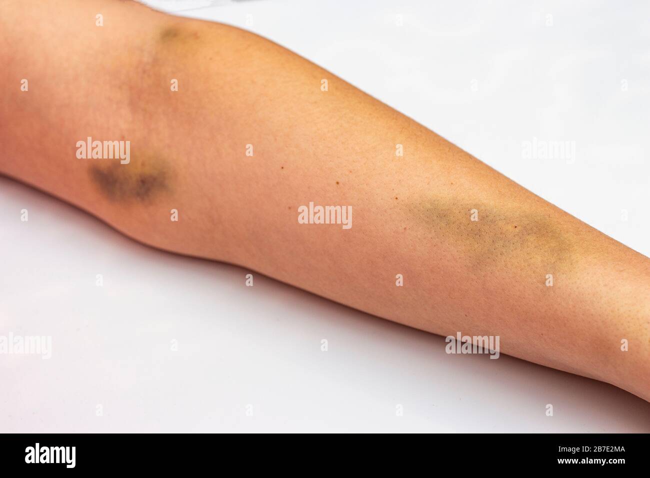 Female hand bruised after male abuse Stock Photo - Alamy