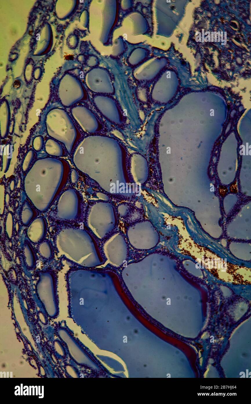 Goiter colloid goiter disease 100x Stock Photo - Alamy