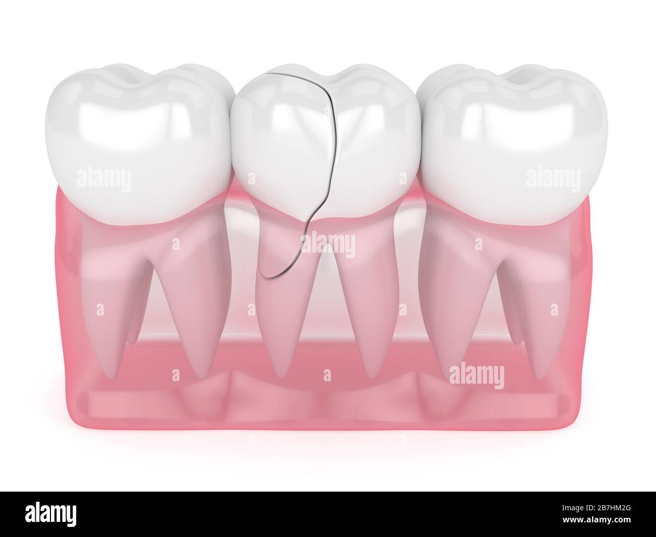 3d render of translucent gums with cracked tooth over white background ...