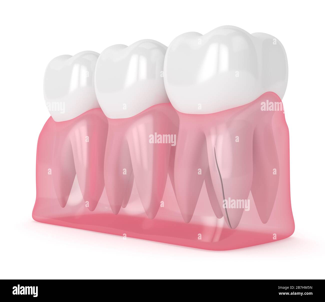3d render of gums with cracked tooth root over white background ...