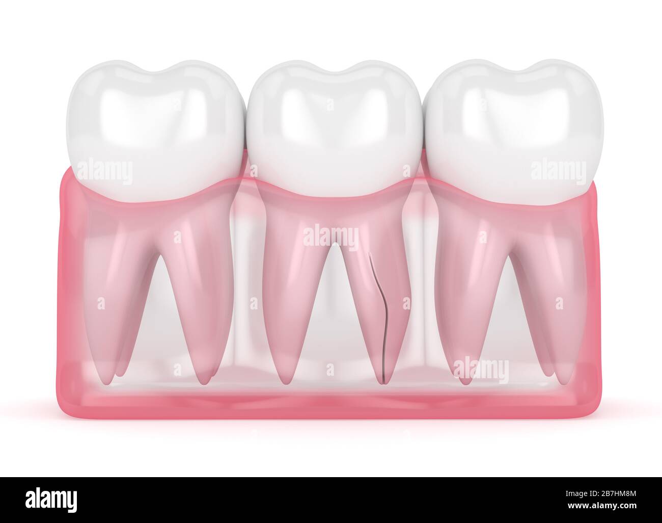 3d render of gums with cracked tooth root over white background ...