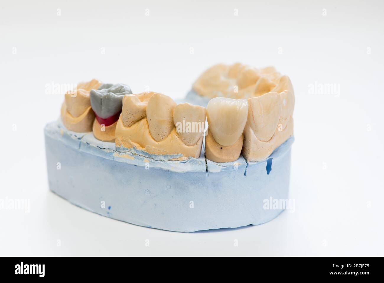 Dental gypsum model in dentist laboratory office - close-up. Gypsum ...
