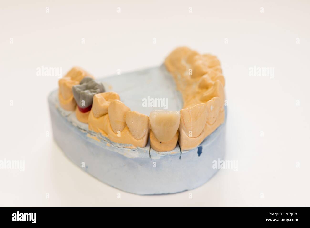 Dental gypsum model in dentist laboratory office - close-up. Gypsum ...