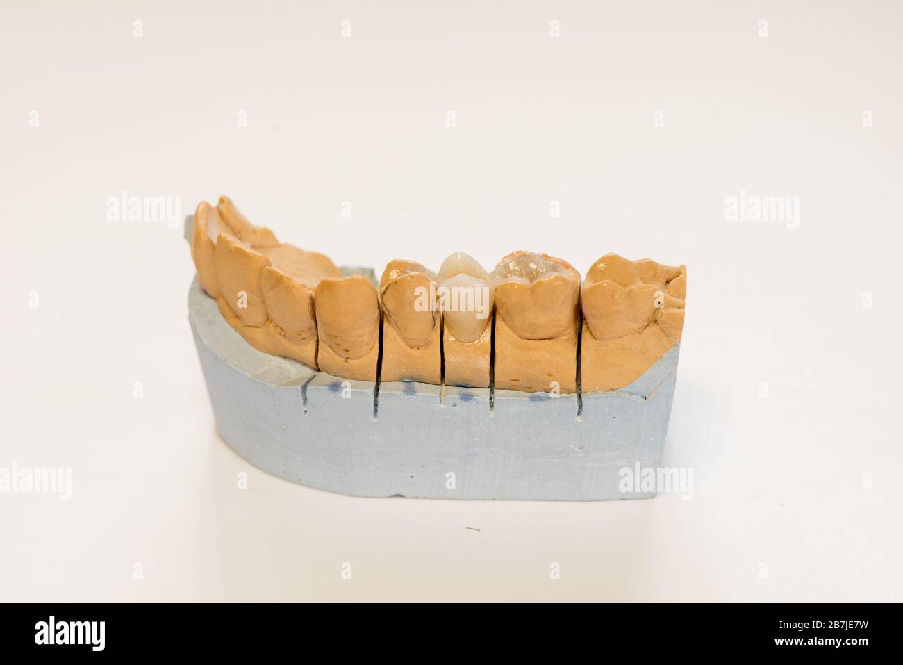 Dental gypsum model in dentist laboratory office - close-up. Gypsum ...
