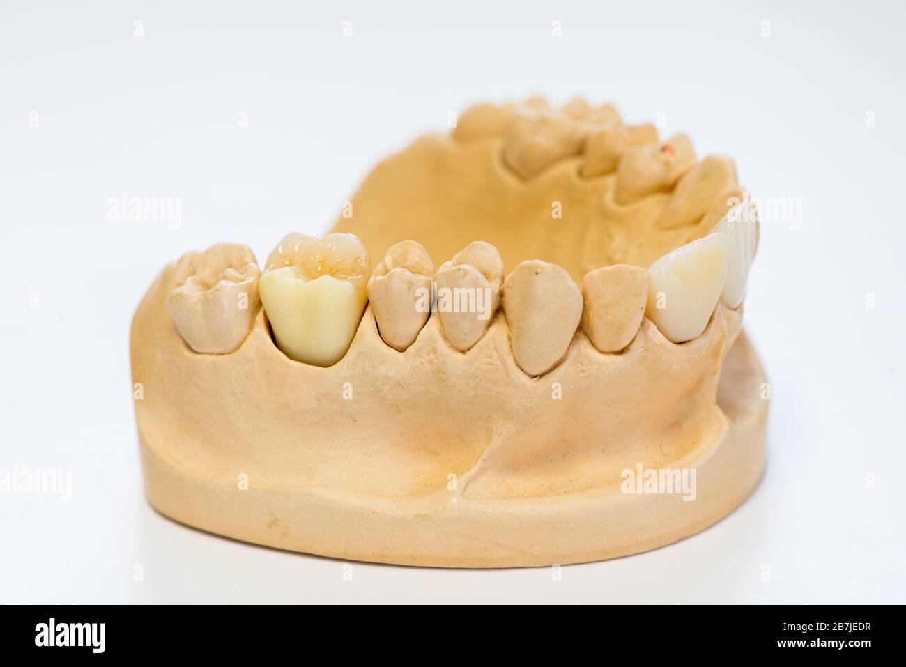 Dental gypsum model in dentist laboratory office - close-up. Gypsum ...