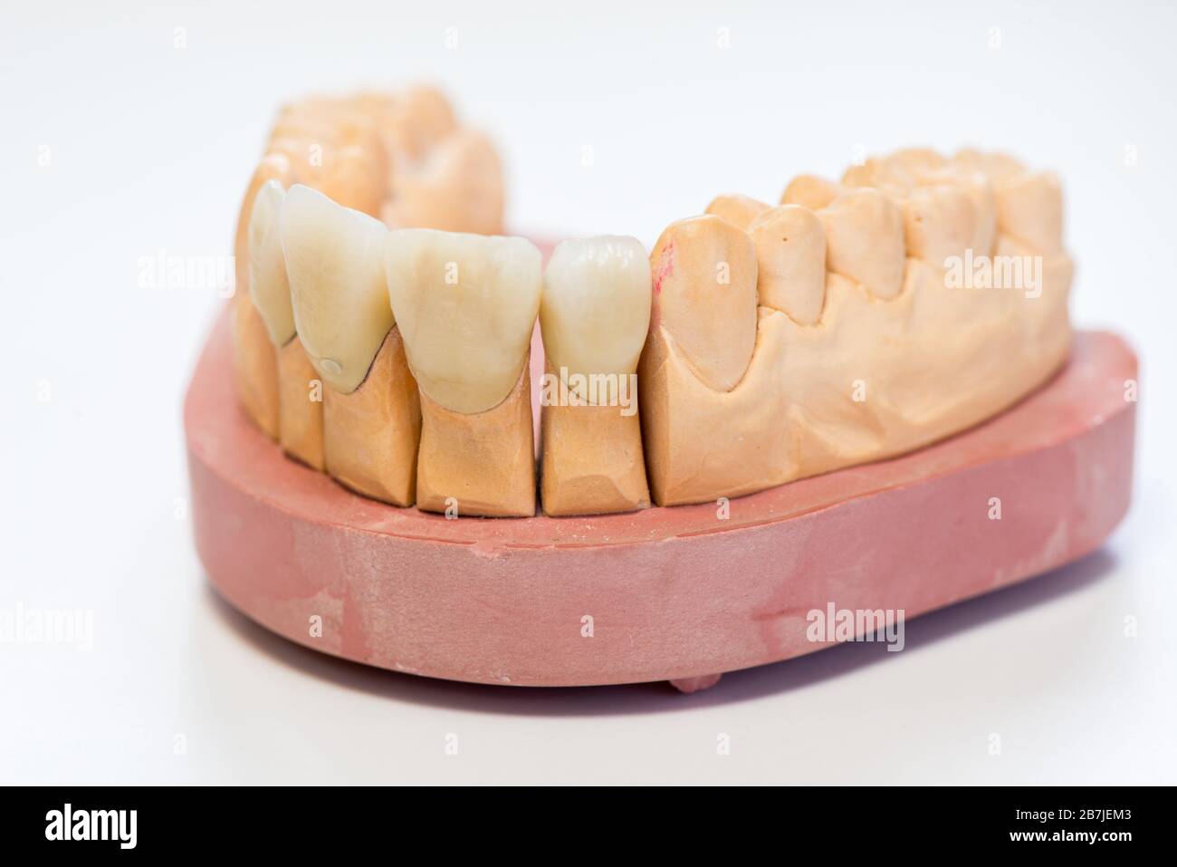 Dental gypsum model in dentist laboratory office - close-up. Gypsum ...