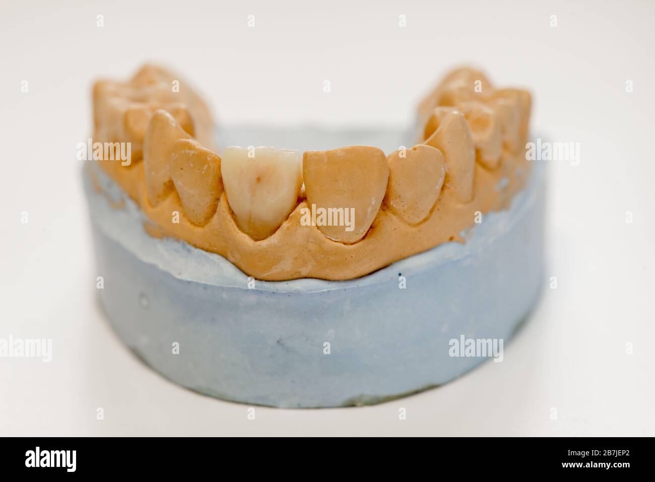 Dental gypsum model in dentist laboratory office - close-up. Gypsum ...